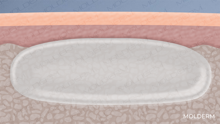 Comparison - MOLDERM
